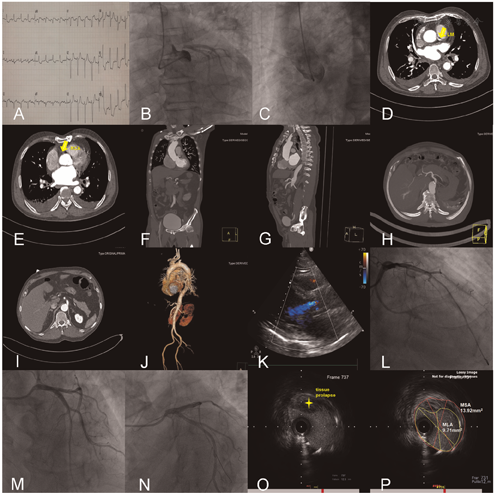 A Rare and Lethal Ostial Left Main Trunk Lesion: A Case Report