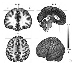 基于VMHC方法的青少年网络成瘾静息态功能磁共振成像研究 - 磁共振成像