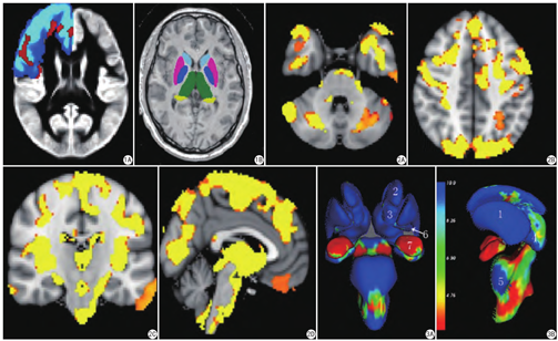 脑型肝豆状核变性脑皮层及皮层下核团体积的磁共振研究 - 磁共振成像