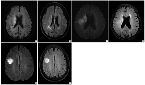 探讨改良DWI-FLAIR不匹配指导醒后缺血性卒中静脉溶栓治疗疗效 - 磁共振成像