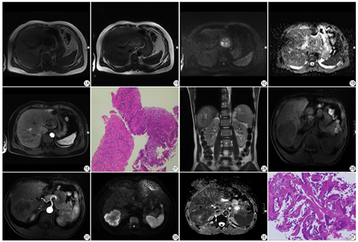 磁共振增强成像联合DWI在不典型肝脓肿及肝脏转移瘤诊断中的应用 - 磁共振成像
