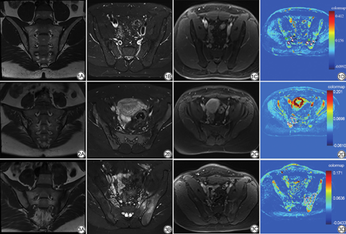 基于DCE-MRI微血管通透性参数量化评估SpA骶髂关节炎症活动性的研究 - 磁共振成像