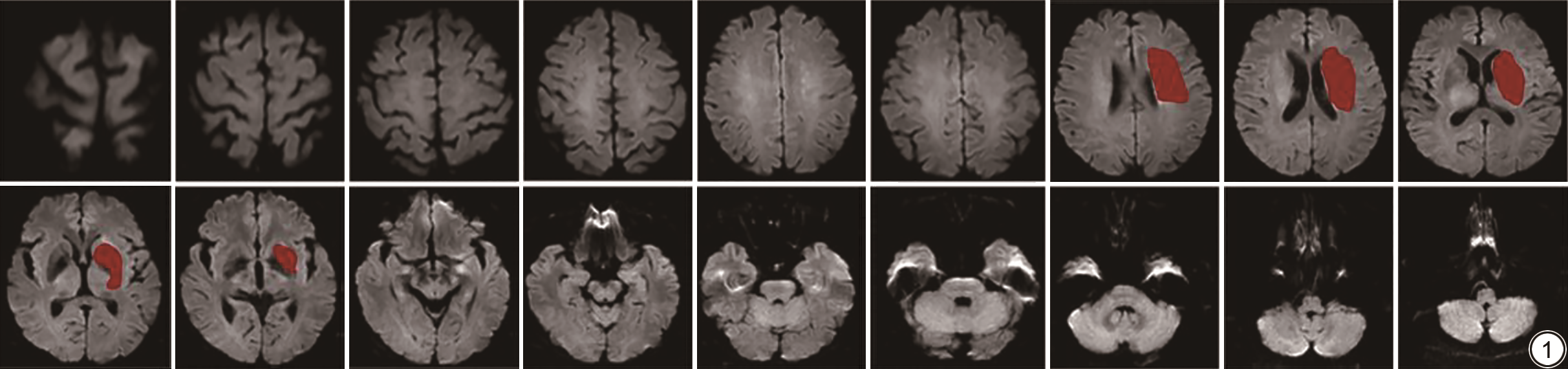 基于DWI的影像组学和机器学习预测急性脑卒中机械取栓后预后 - 磁共振成像