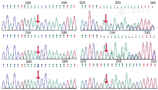 VPS13D 基因突变导致隐性遗传性脊髓小脑共济失调4型一例