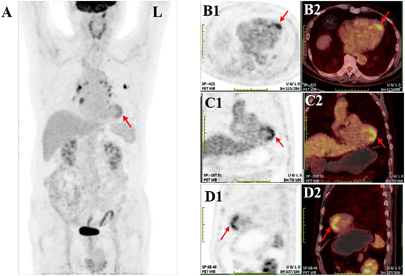 肿瘤PET/CT显像偶发心肌18F-FDG局灶性摄取提示冠心病一例 - 中国临床案例成果数据库