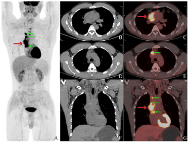 心包去分化脂肪肉瘤18F-FDG PET/CT表现一例 - 中国临床案例成果数据库