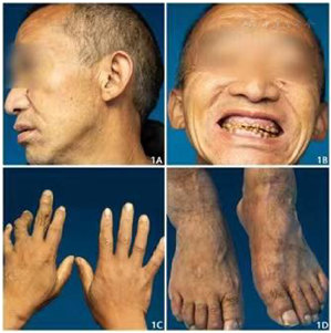 Cowden综合征1例 - 中国临床案例成果数据库