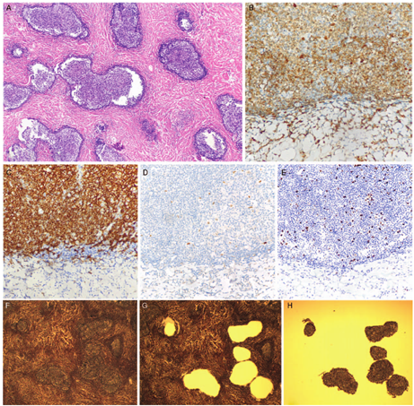 Primary lung mucosa-associated lymphoid tissue lymphoma accompanied by ...