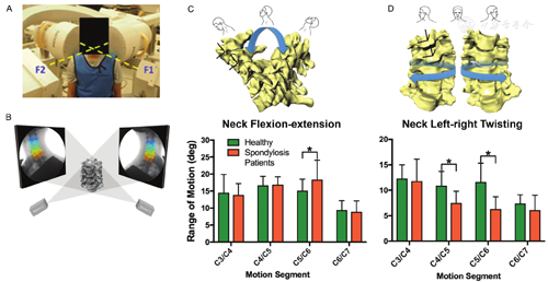 In vivo ranges of motion of cervical segments in patients with cervical ...