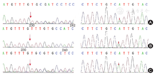 SLC2A2基因变异致Fanconi-Bickel综合征一例 - 中华儿科杂志