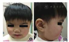 WAC基因致病性变异致DeSanto-Shinawi综合征伴睡眠期癫痫性电持续状态一例 - 中华儿科杂志