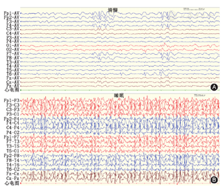 WAC基因致病性变异致DeSanto-Shinawi综合征伴睡眠期癫痫性电持续状态一例 - 中华儿科杂志