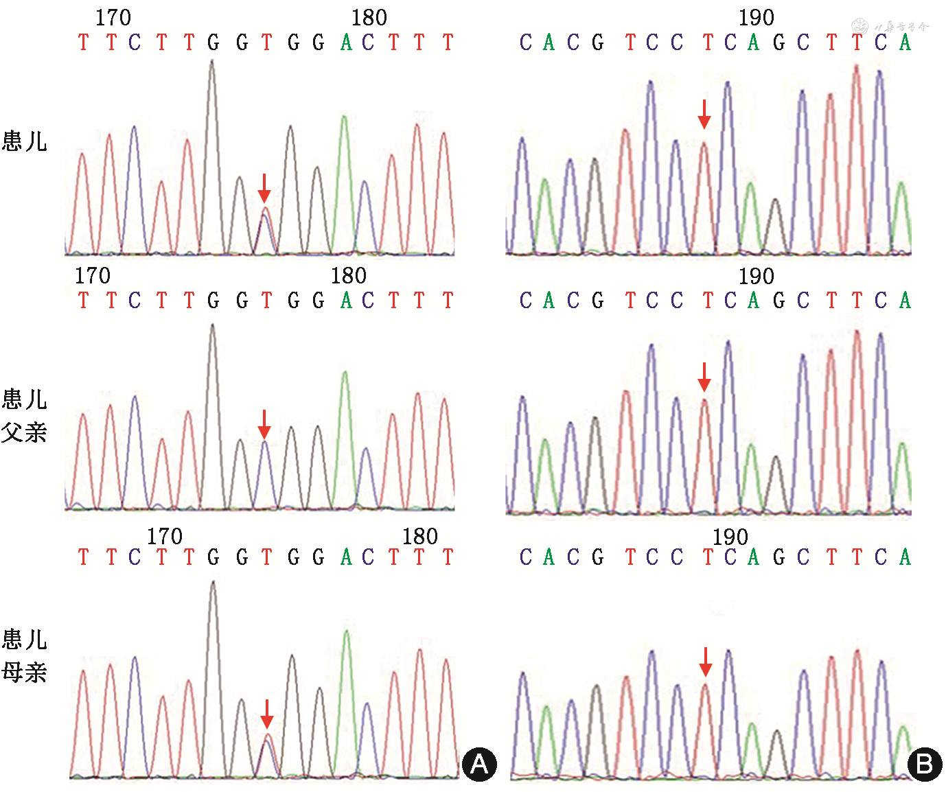 RMRP基因新发变异致软骨毛发发育不全并重症联合免疫缺陷病一例
