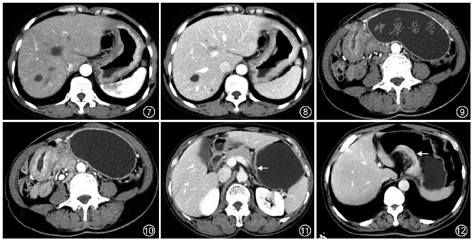 CT对胃癌诊断和临床应用价值 - 中华放射学杂志