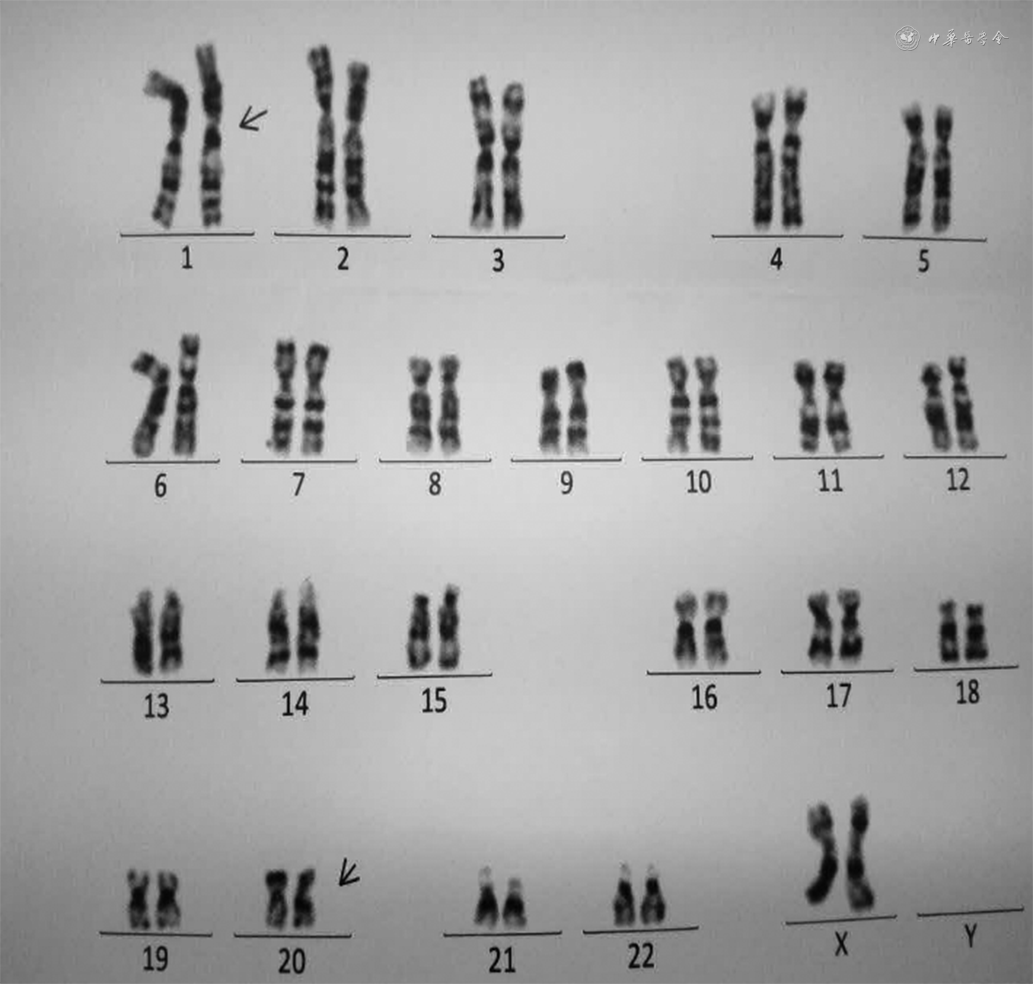Inv（20）伴不孕症和多囊卵巢综合征一家系