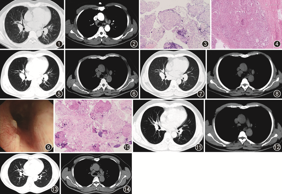 皮肤结节—纵隔—肺门淋巴结肿大 - 中华结核和呼吸杂志