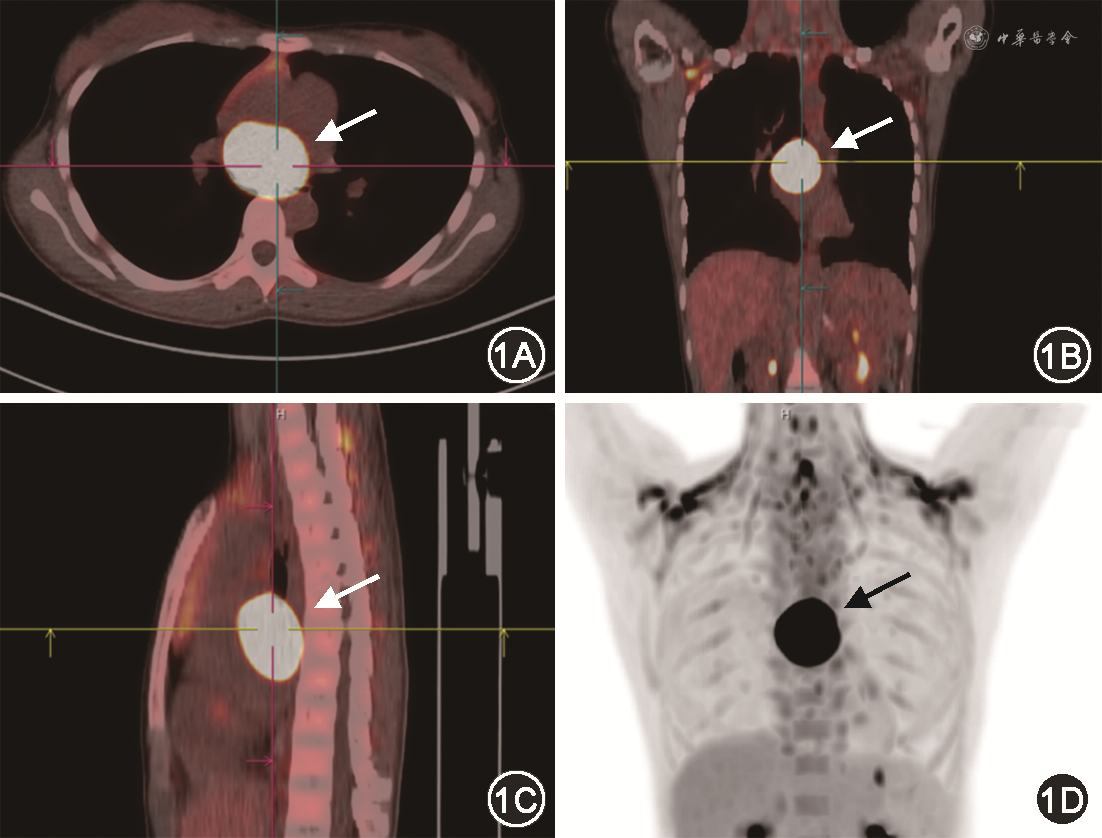 SDHB基因错义突变致心脏副神经节瘤一例 - 中华内科杂志