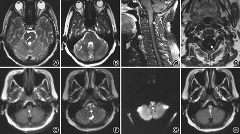 有颈髓损害和视网膜中央动脉闭塞的Susac综合征一例 - 中华神经科杂志