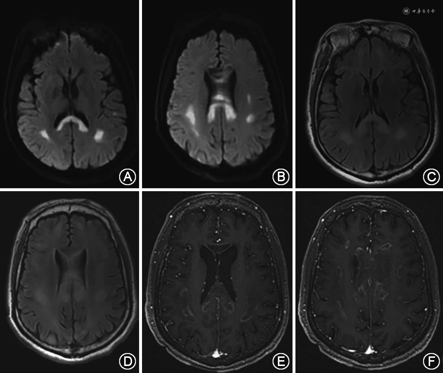 呼吸道冠状病毒-NL63感染致急性坏死性脑炎一例 - 中华神经科杂志
