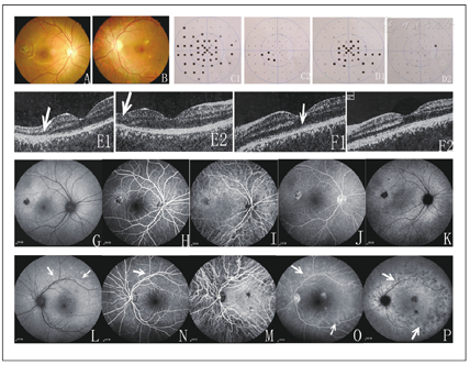急性区域性隐匿性外层视网膜病变的眼底光学影像学特征及意义 - 中国实用眼科杂志