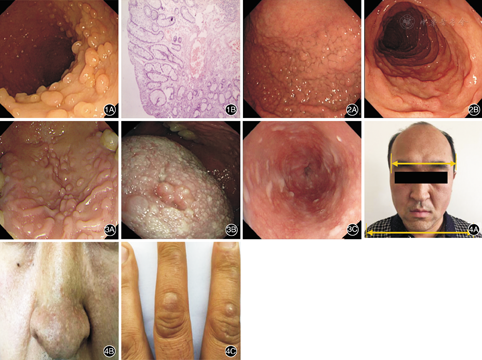 Cowden综合征一例诊断体会 - 中华消化内镜杂志