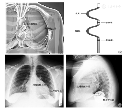 2019年美国心律学会年会心脏起搏领域最新临床研究 - 中华心律失常学杂志