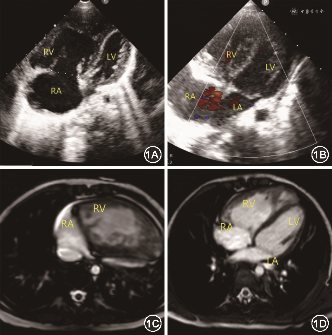 急诊Potts分流术治疗儿童特发性重度肺动脉高压一例 - 中华心血管病杂志