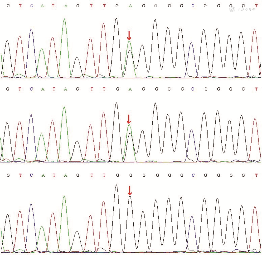 Liddle综合征妇女妊娠一例 - 中华心血管病杂志