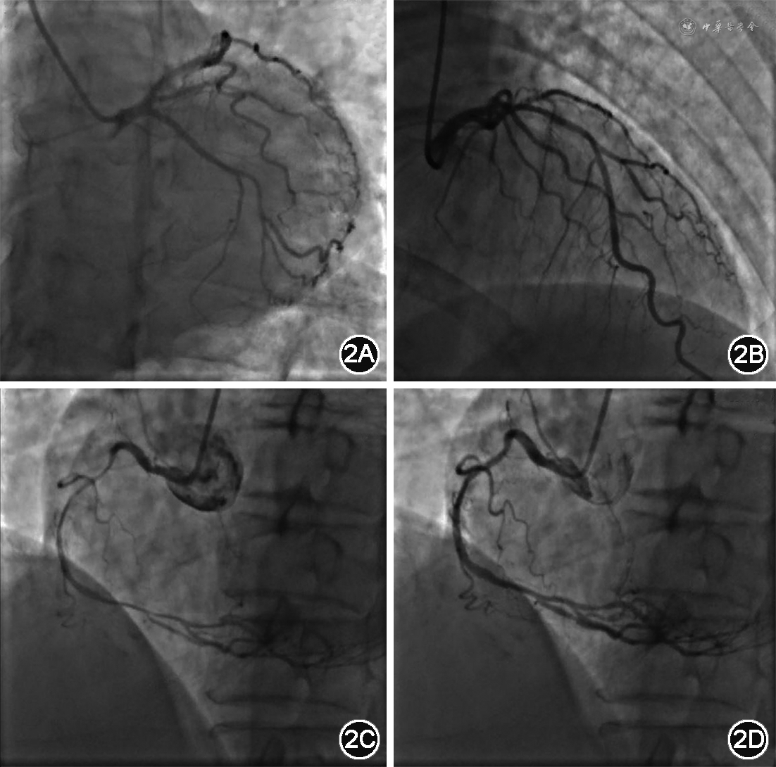 Ⅱ型Kounis综合征一例