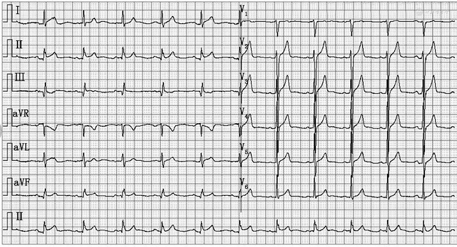 Ⅱ型Kounis综合征一例