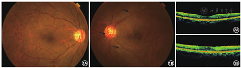 超广角荧光素眼底血管造影随访诊疗特发性IRVAN综合征一例 - 中华眼科杂志