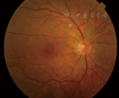 Goldmann-Favre综合征一例 - 中华眼科杂志