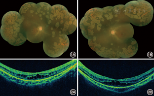 回旋状脉络膜视网膜萎缩一例 - 中华眼科杂志