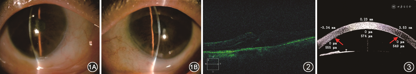无内皮移植的角膜后弹力层剥除术治疗Fuchs角膜内皮营养不良1例 - 中华眼科杂志