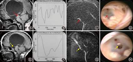 神经内镜下第三脑室底造瘘术治疗儿童脑积水的疗效评估 - 中华医学杂志