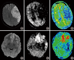 磁共振3D-pcASL灌注成像在鉴别急性脑梗死和脑炎的应用价值 - 中华医学杂志