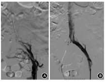 球囊不同扩张时机在Cockett综合征合并左下肢深静脉血栓中的对比观察 - 中华医学杂志