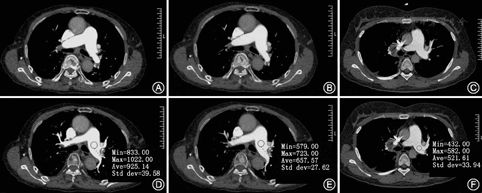 双源CT肺动脉血管成像双能量模式联合高级模拟迭代重建的图像质量对比价值分析 - 中华医学杂志