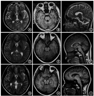 PLA2G6复合杂合突变所致不典型神经轴索营养不良一家系分析 - 中华医学杂志