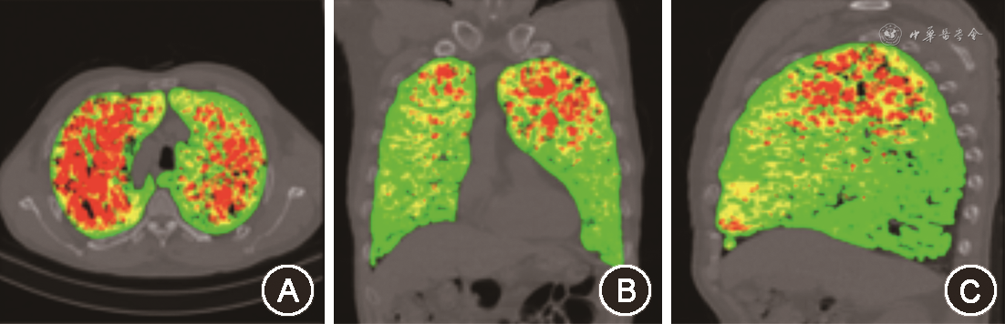 基于吸呼双相CT定量参数的慢性阻塞性肺疾病影像学表型研究 - 中华医学杂志