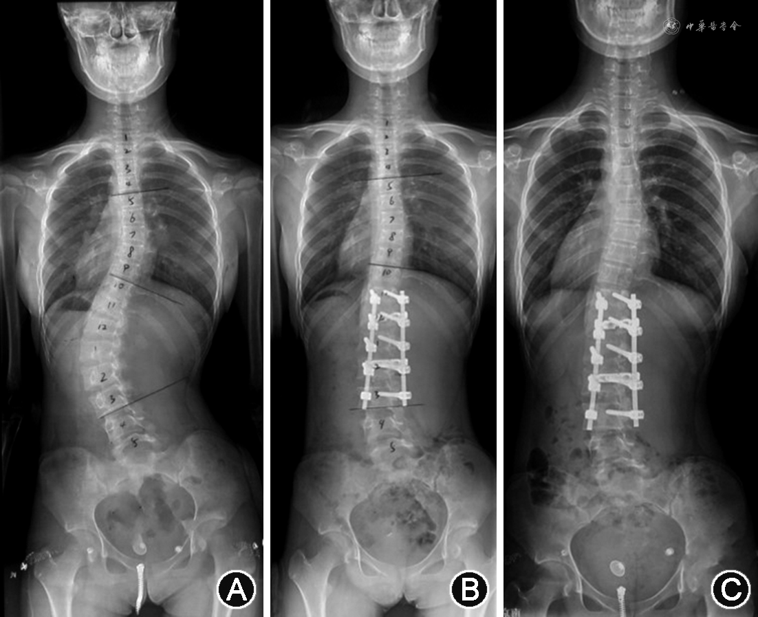Lenke 5C型青少年特发性脊柱侧凸的上端固定椎设为端椎下方一个椎体的随访研究 - 中华医学杂志