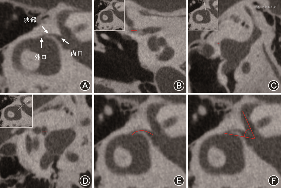 基于10 μm级耳科专用CT的前庭神经管影像解剖特征分析 - 中华医学杂志