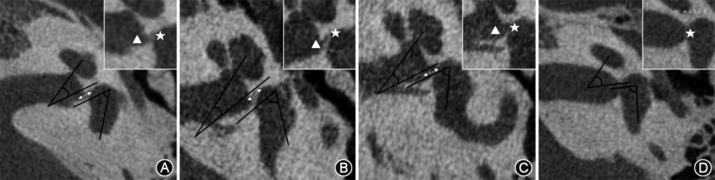 基于10 μm级耳科专用CT的前庭神经管影像解剖特征分析 - 中华医学杂志