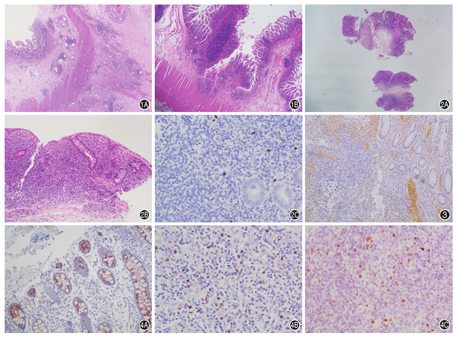 对EB病毒感染性肠道疾病的认识 - 中华炎性肠病杂志