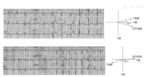 平面QRS-T夹角与慢性心功能不全的临床分析 - 中国心血管杂志