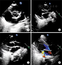 Hurler综合征患儿心脏超声表现1例 - 中华超声影像学杂志