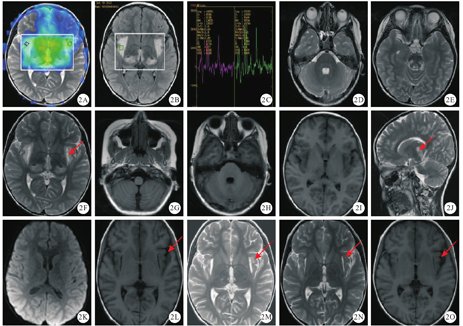 RANBP2基因突变致家族性急性坏死性脑病患儿的诊治并文献复习 - 中华妇幼临床医学杂志(电子版)