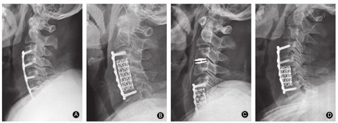脊髓型颈椎病手术入路及减压融合方式的选择策略 - 中华骨科杂志