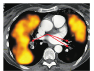SPECT和SPECT/CT肺通气/灌注显像 - 中华核医学与分子影像杂志