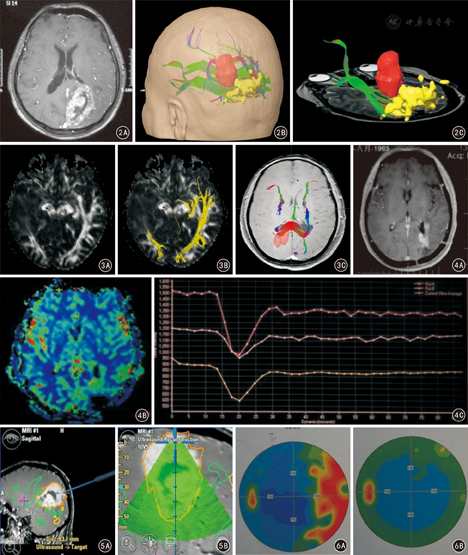多模态MRI技术结合神经导航术中超声在枕叶视觉功能区胶质瘤手术中的应用 - 中华解剖与临床杂志